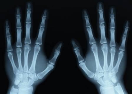 When was the X-Ray discovered? – When was it invented?